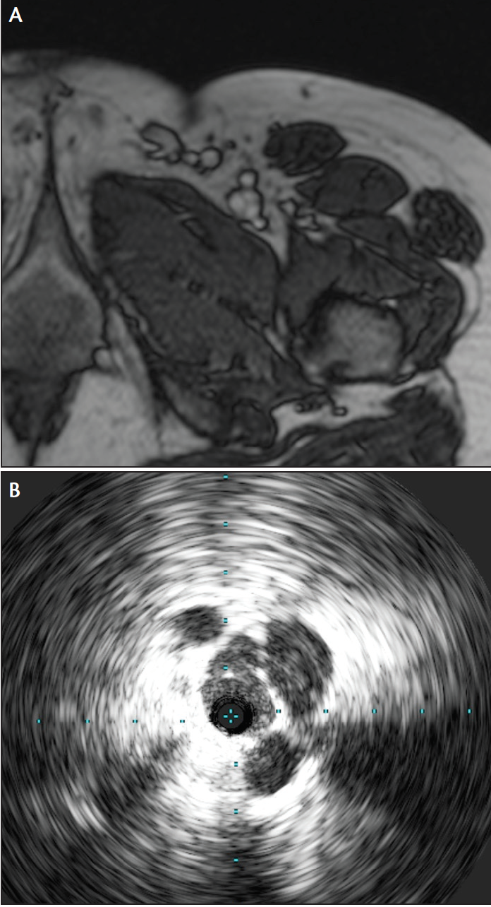 Treating the DVO Picture: Significance of Imaging in Relation to the ...