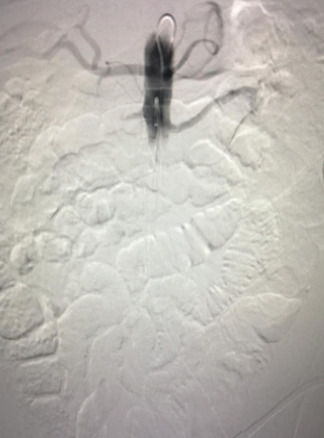 Indigo® System for Thromboembolic Disease - Endovascular Today