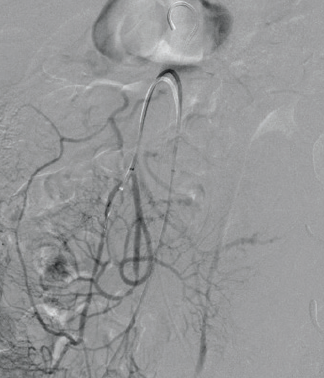 Indigo® System for Thromboembolic Disease - Endovascular Today