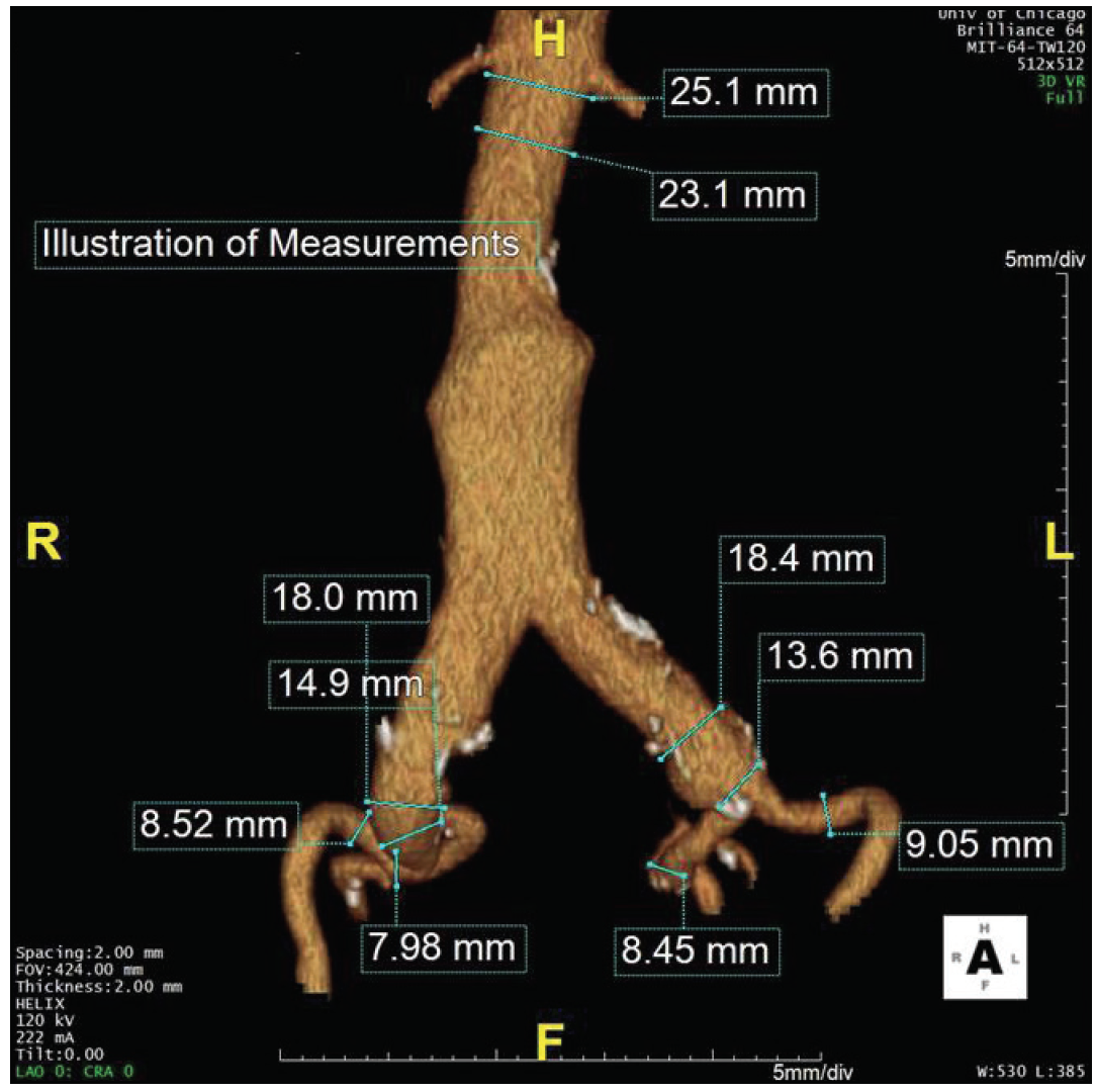 Case Planning for an Iliac Branch Endoprosthesis Procedure ...