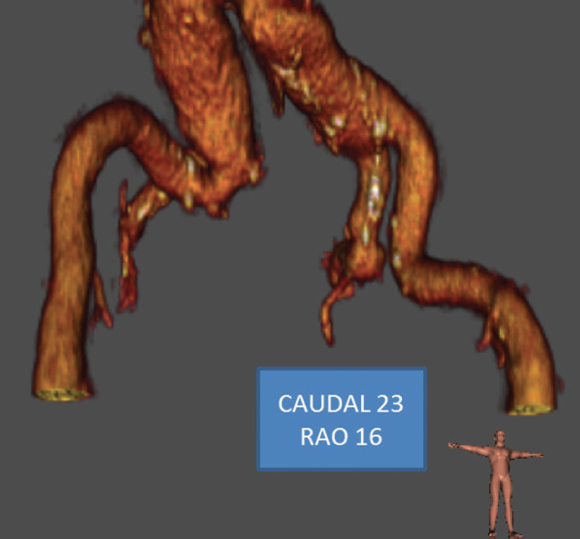 Imaging Considerations for the GORE® EXCLUDER® Iliac Branch ...