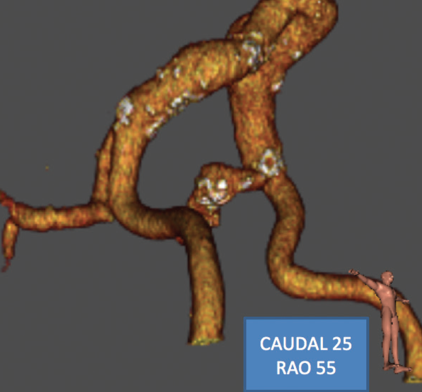 Imaging Considerations for the GORE® EXCLUDER® Iliac Branch ...