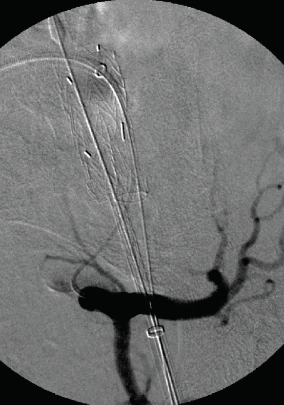 Imaging Considerations for the GORE® EXCLUDER® Iliac Branch ...