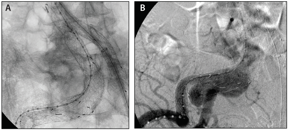 Imaging Considerations for the GORE® EXCLUDER® Iliac Branch ...