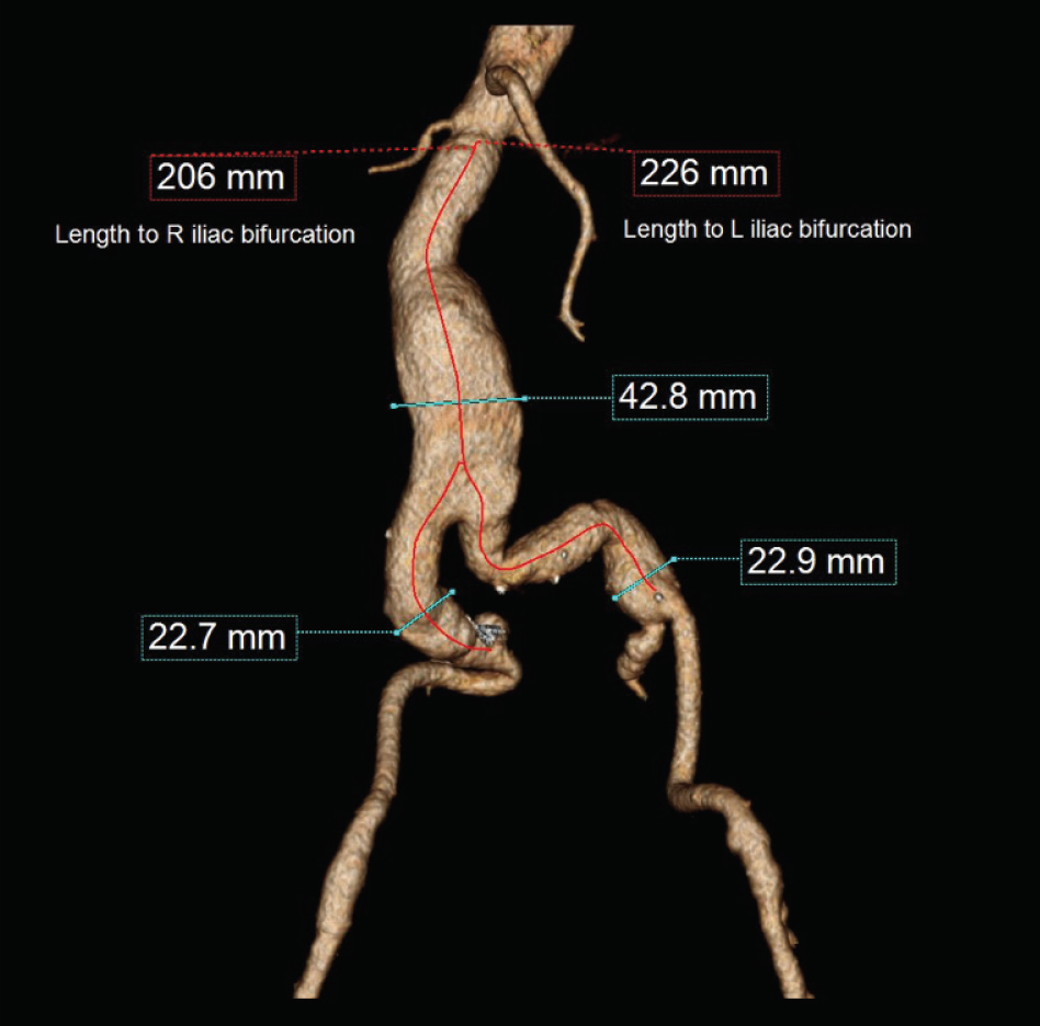 Case Report: Managing an Infrarenal AAA With Significant Iliac ...
