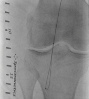 Critical Limb Ischemia and Gangrene - Endovascular Today