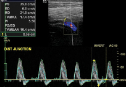 What Goes Around Comes Around: Fully Endovascular Femoropopliteal ...
