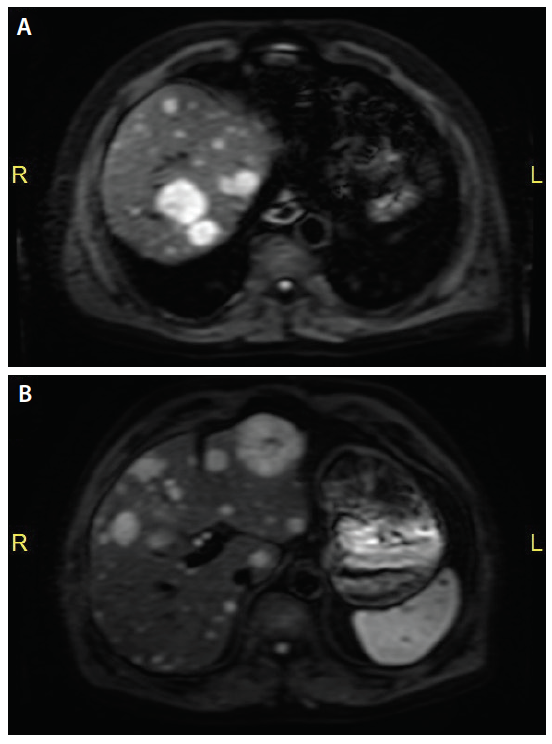 Embozene™ Microspheres for Treatment of Neuroendocrine Tumors ...