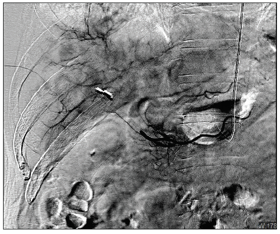 Embozene™ Microspheres for Treatment of Neuroendocrine Tumors ...