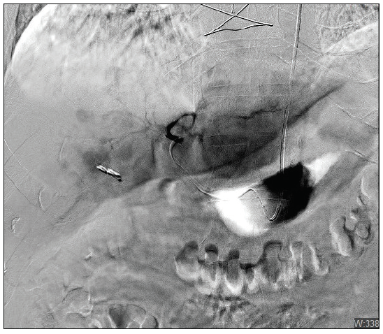 Embozene™ Microspheres for Treatment of Neuroendocrine Tumors ...