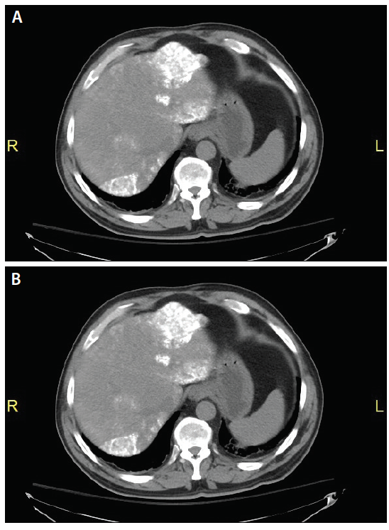 Embozene™ Microspheres for Treatment of Neuroendocrine Tumors ...