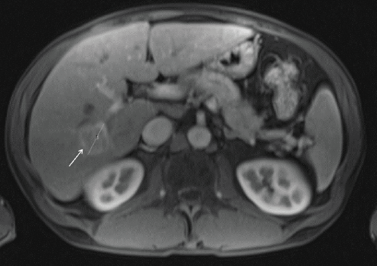 Yttrium-90 Segmentectomy Flow Diversion Using Embozene™ Microspheres ...