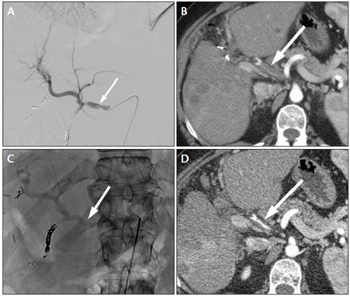 Ten Interventional Oncology Pitfalls - Endovascular Today