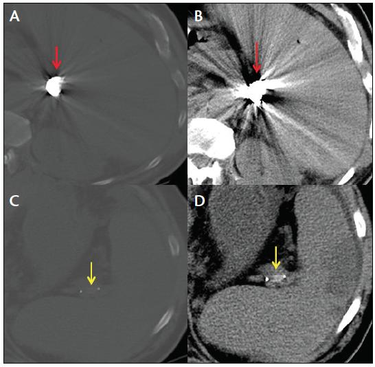 Reduced Metal Artifacts on CT Utilizing the Medtronic MVP ...