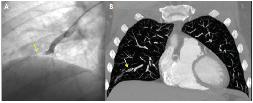 Reduced Metal Artifacts on CT Utilizing the Medtronic MVP ...