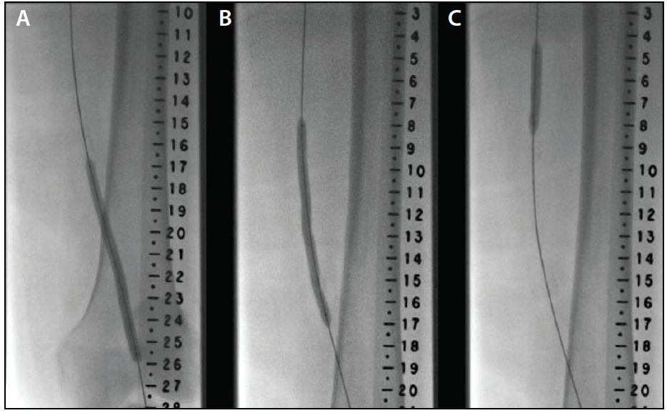 Case Study: Complex Long Lesion Intervention With the Lutonix® 035 Drug ...