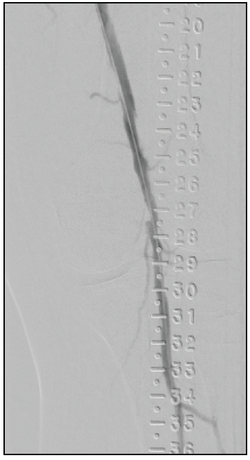Case Study: Complex Long Lesion Intervention With the Lutonix® 035 Drug ...