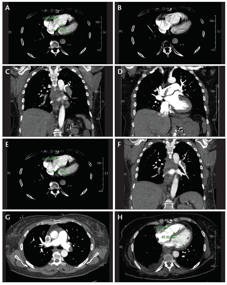 Implementation of the OPTALYSE Study for Submassive Pulmonary Embolism ...