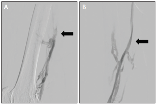 EKOS® Therapy Restores Quality of Life in Patients With Postthrombotic ...