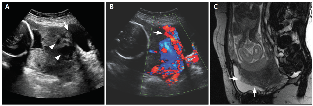 Treating Postpartum Hemorrhage and Invasive Placenta - Endovascular Today
