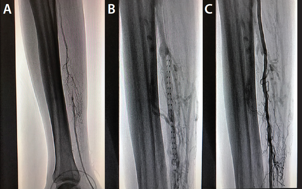 The Benefit of Cryoplasty in the Office-Based Lab - Endovascular Today
