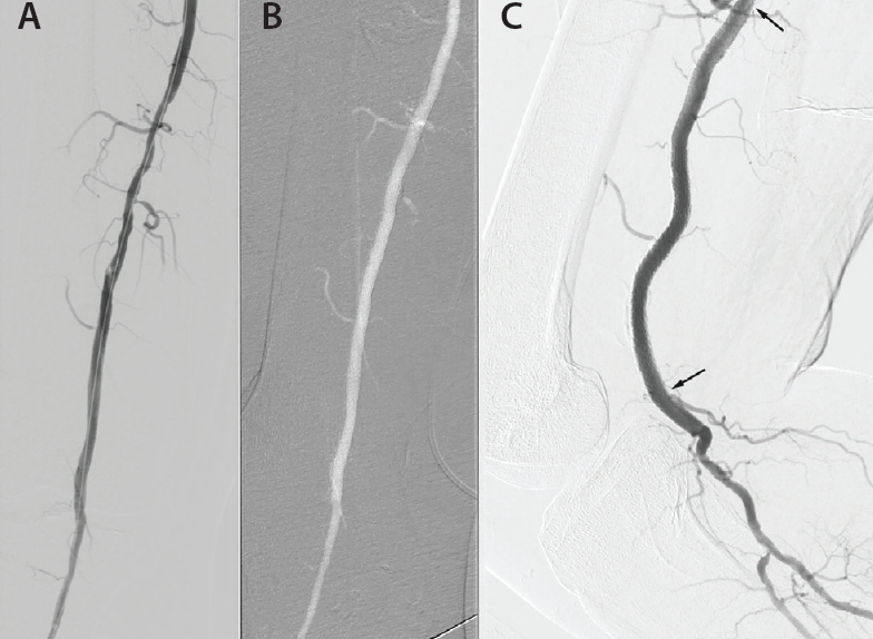 Case Report: GORE® TIGRIS® Vascular Stent Implantation in Segmental ...