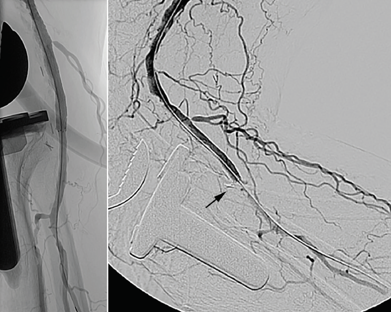 Case Report: GORE® TIGRIS® Vascular Stent Implantation in Segmental ...