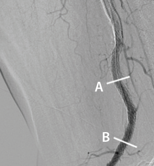 IVUS for GORE® TIGRIS® Vascular Stent Placement During Knee Flexion ...