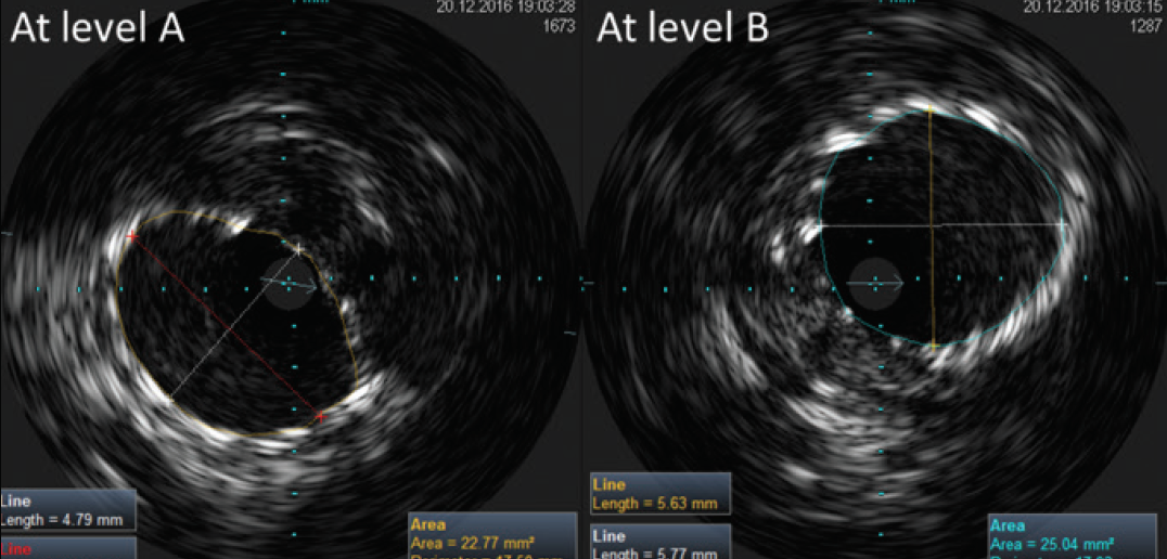 IVUS for GORE® TIGRIS® Vascular Stent Placement During Knee Flexion ...
