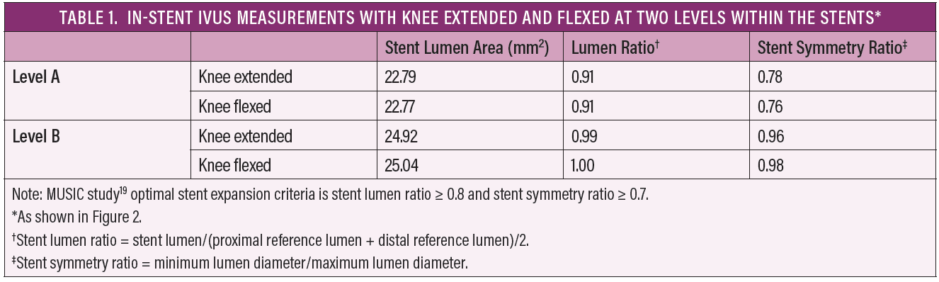 IVUS for GORE® TIGRIS® Vascular Stent Placement During Knee Flexion ...