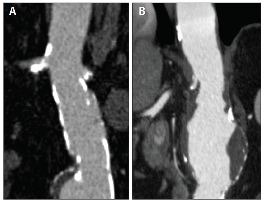 What Constitutes a Compromised Aortic Neck in 2018? - Endovascular Today