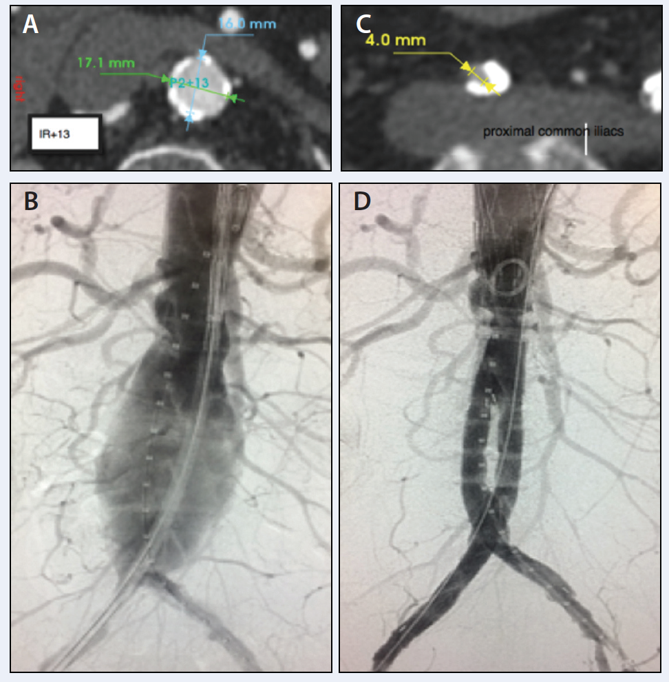The Ovation Abdominal Stent Graft Creates a Patient-Specific EVAR Seal ...