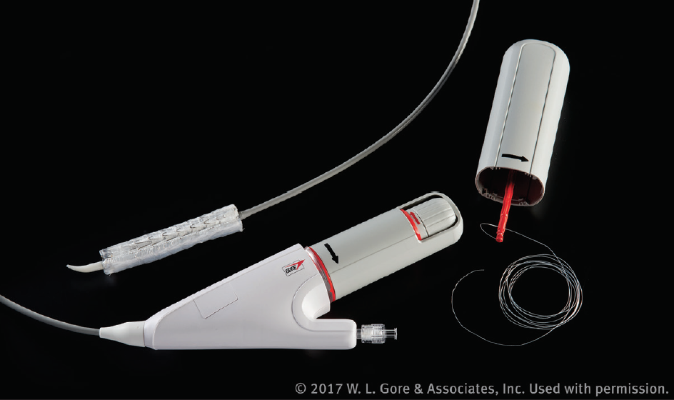 Early Experience Using the GORE® TAG® Conformable Thoracic Stent Graft ...