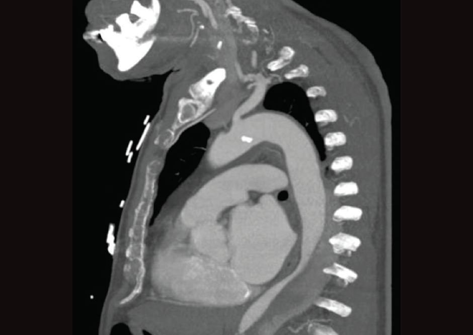 Early Experience Using the GORE® TAG® Conformable Thoracic Stent Graft ...