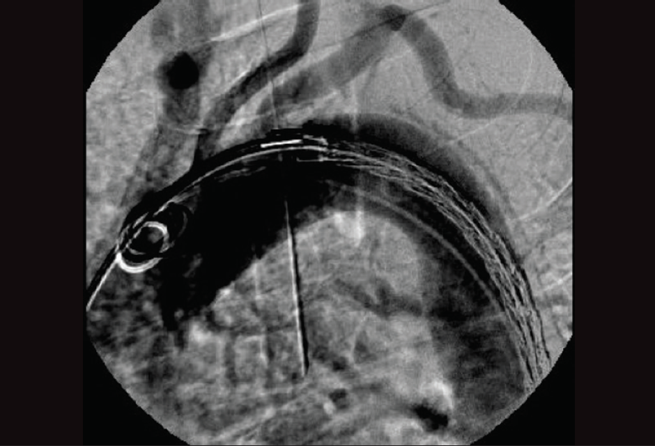 Early Experience Using the GORE® TAG® Conformable Thoracic Stent Graft ...