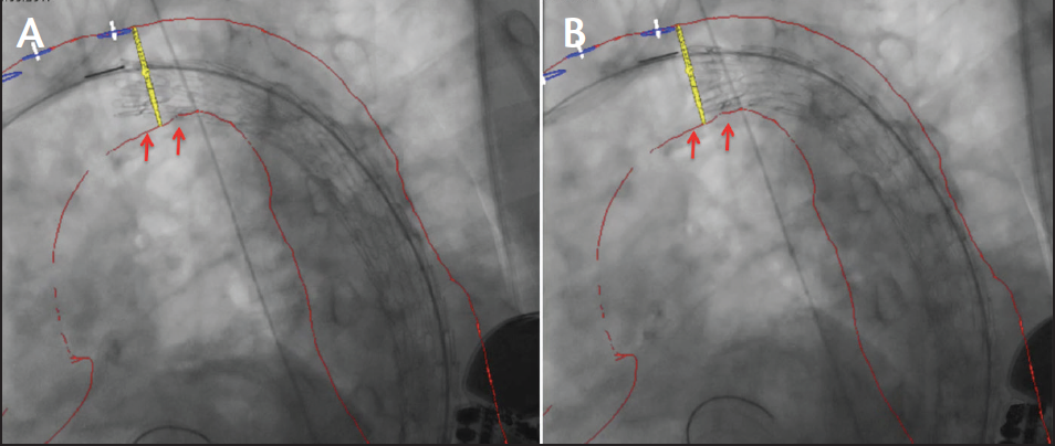 Early Results and Lessons Learned With the GORE® TAG® Conformable ...