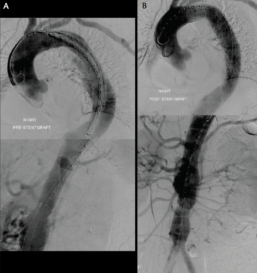 Optimizing TEVAR Outcomes in Acute and Subacute Type B Aortic ...