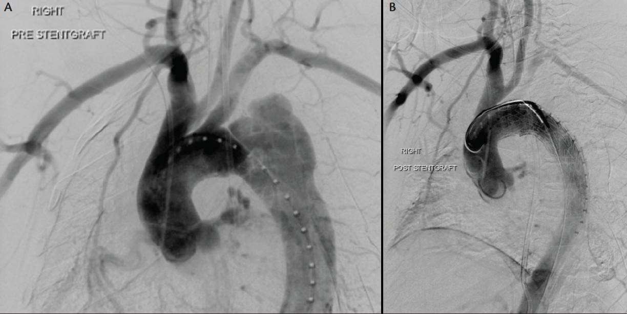 Optimizing TEVAR Outcomes in Acute and Subacute Type B Aortic ...