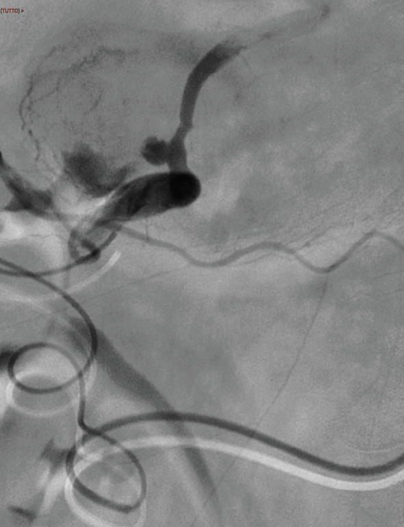 Ruby Coil and POD System: Tools for Dense and Durable Embolisation ...