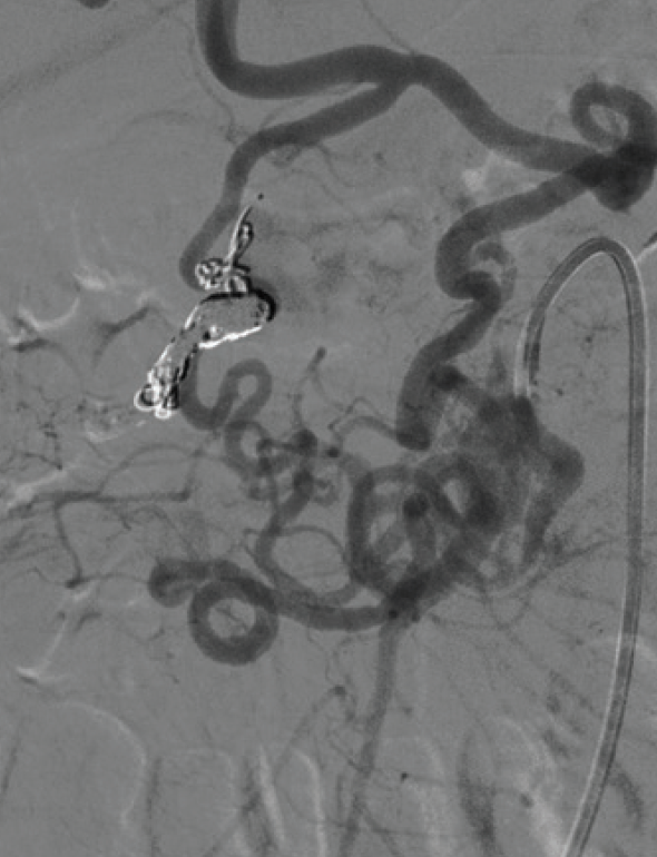 Ruby Coil and POD System: Tools for Dense and Durable Embolisation ...