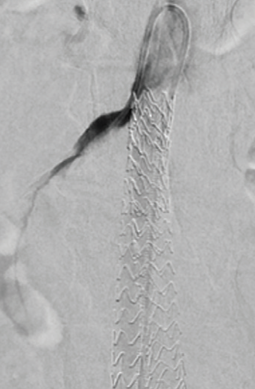 Ruby Coil and POD System: Tools for Dense and Durable Embolisation ...