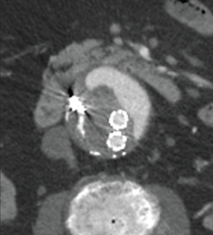 Ruby Coil and POD System: Tools for Dense and Durable Embolisation ...