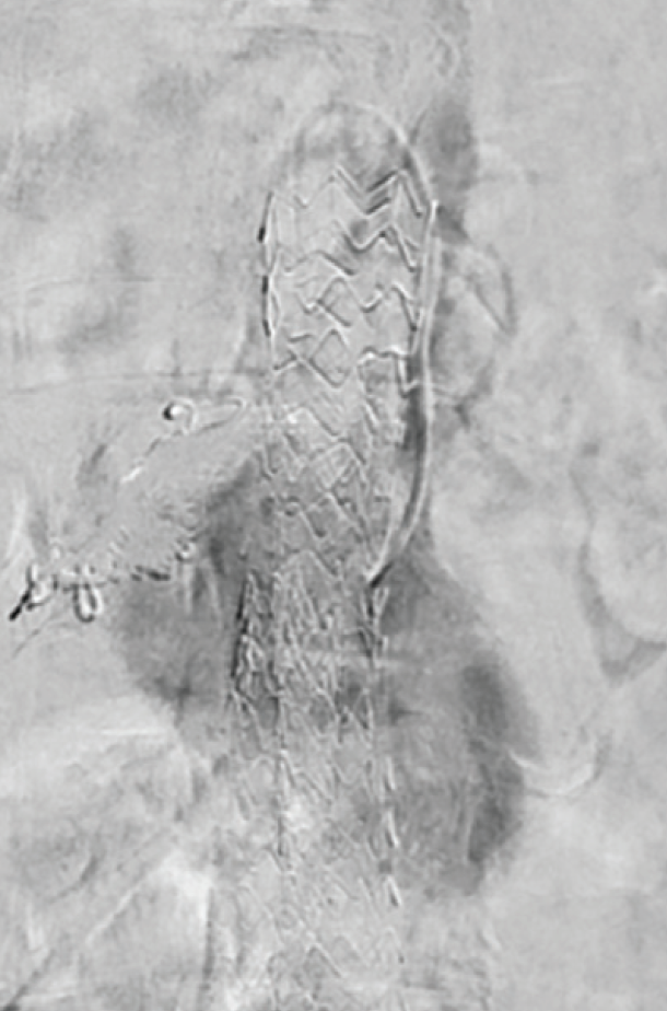 Ruby Coil and POD System: Tools for Dense and Durable Embolisation ...