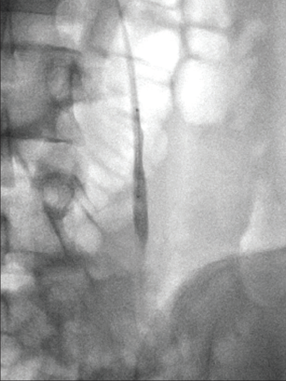 Ruby Coil and POD System: Tools for Dense and Durable Embolisation ...