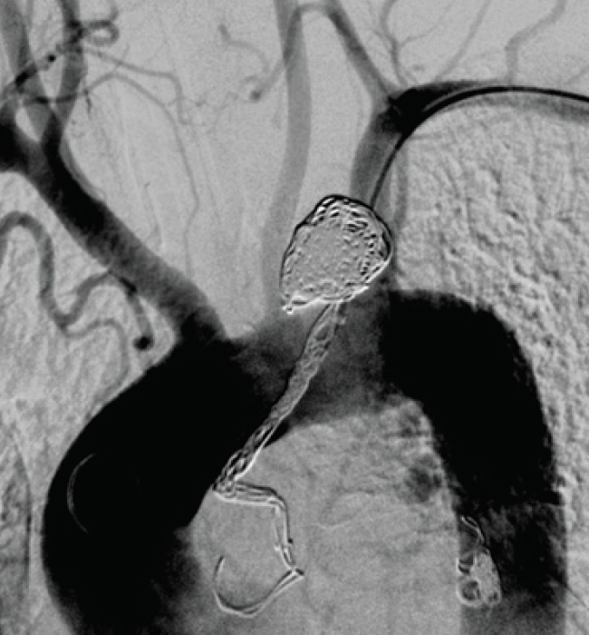 Ruby Coil and POD System: Tools for Dense and Durable Embolisation ...