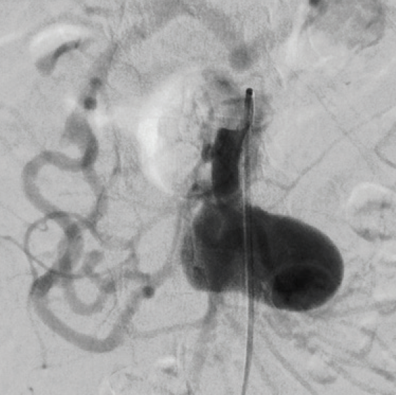 Ruby Coil and POD System: Tools for Dense and Durable Embolisation ...