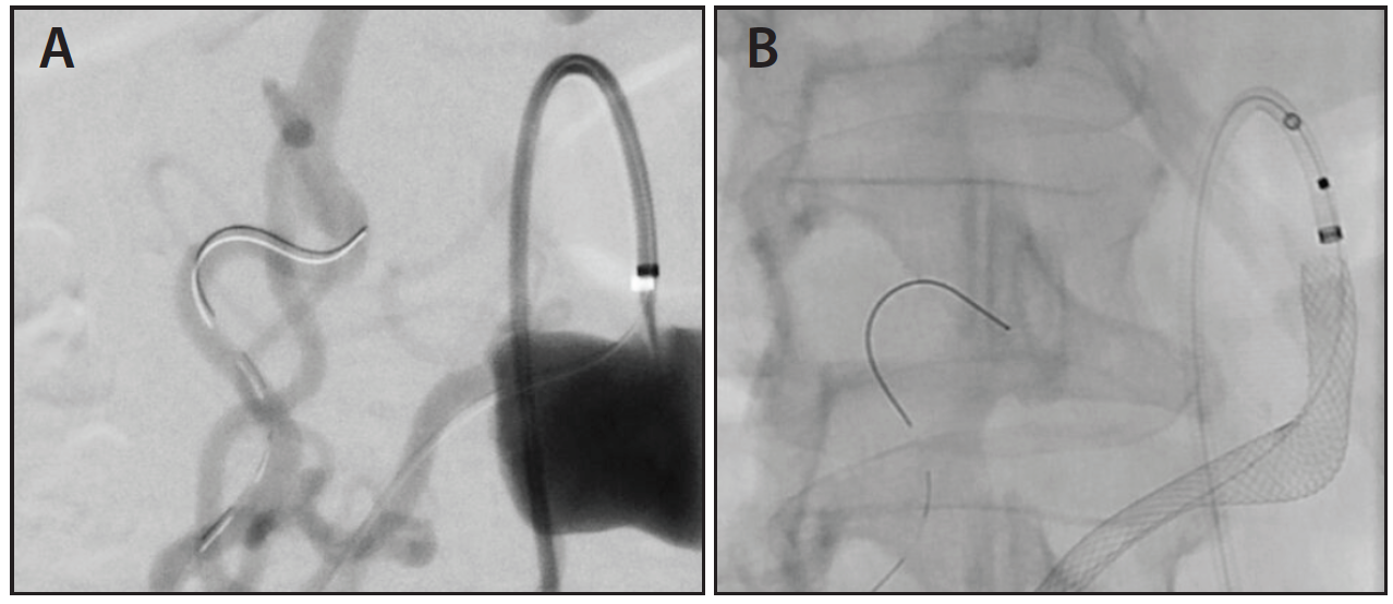 Ruby Coil and POD System: Tools for Dense and Durable Embolisation ...