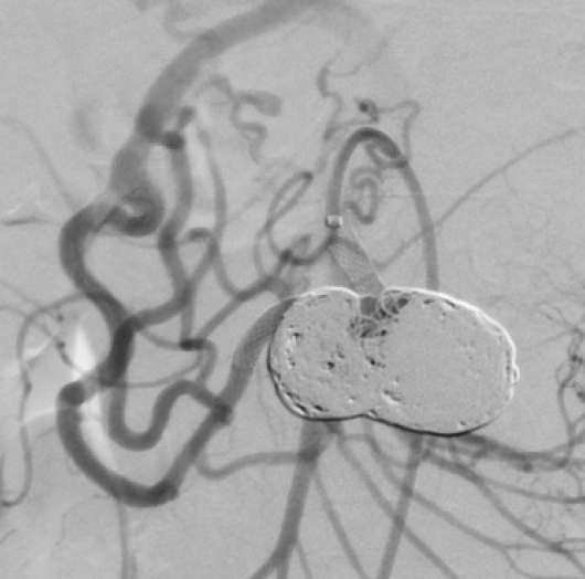 Ruby Coil and POD System: Tools for Dense and Durable Embolisation ...