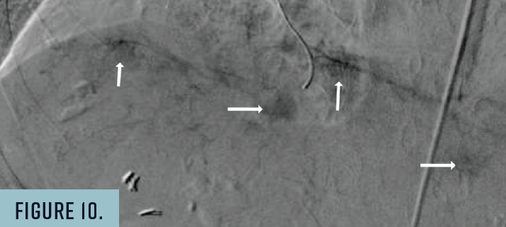 Case Report: Transarterial Embolization of Neuroendocrine Tumor Liver ...