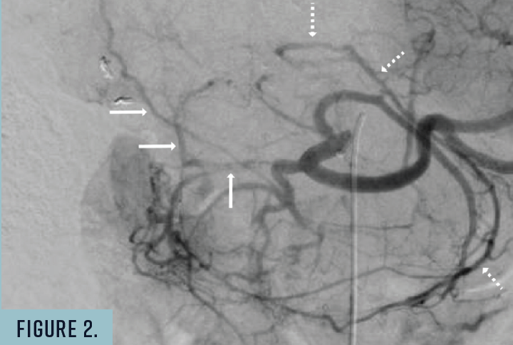 Case Report: Transarterial Embolization of Neuroendocrine Tumor Liver ...
